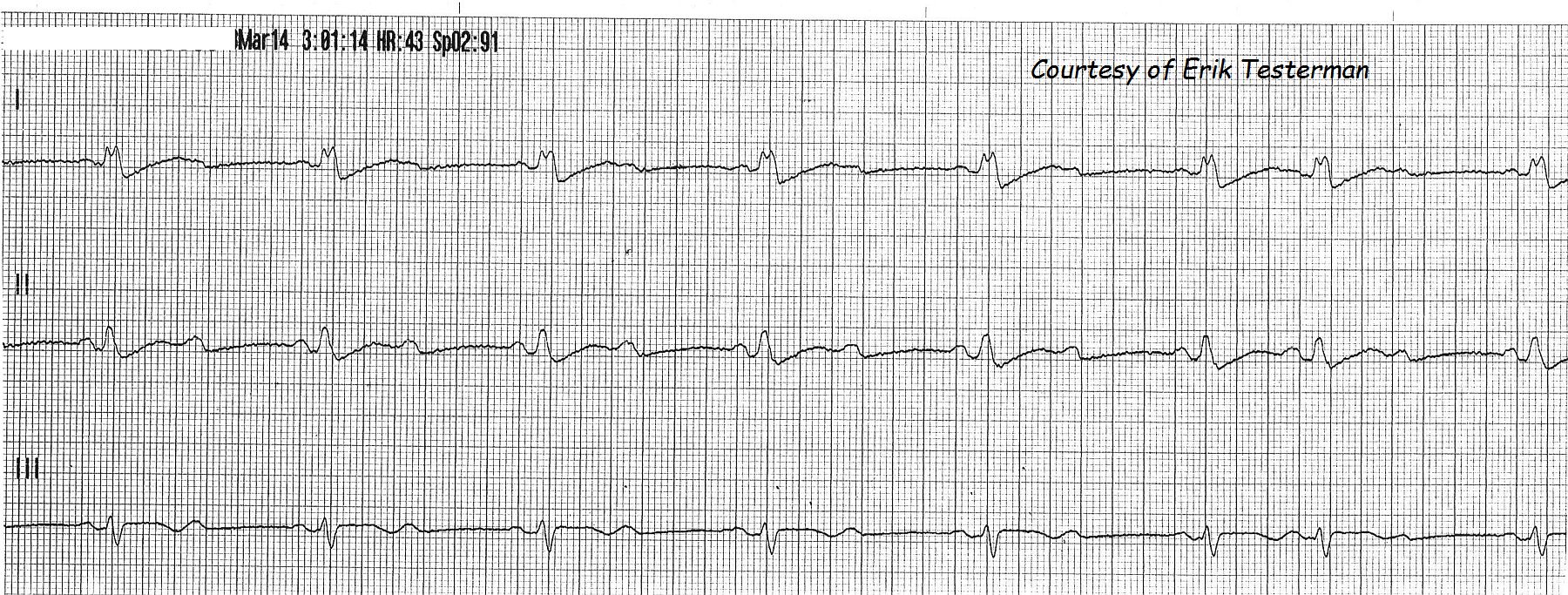 Second-degree A-V Block | ECG Guru - Instructor Resources Second-degree A-V Block | ECG Guru - Instructor Resources